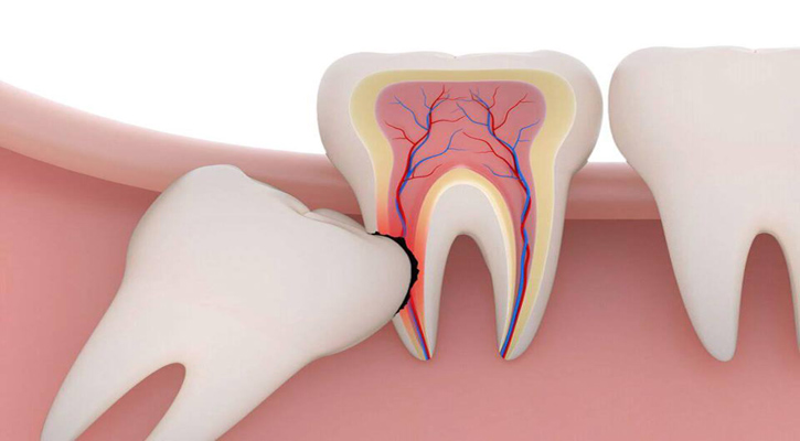 আক্কেল দাঁত নিয়ে যতো ভুল ধারনা!